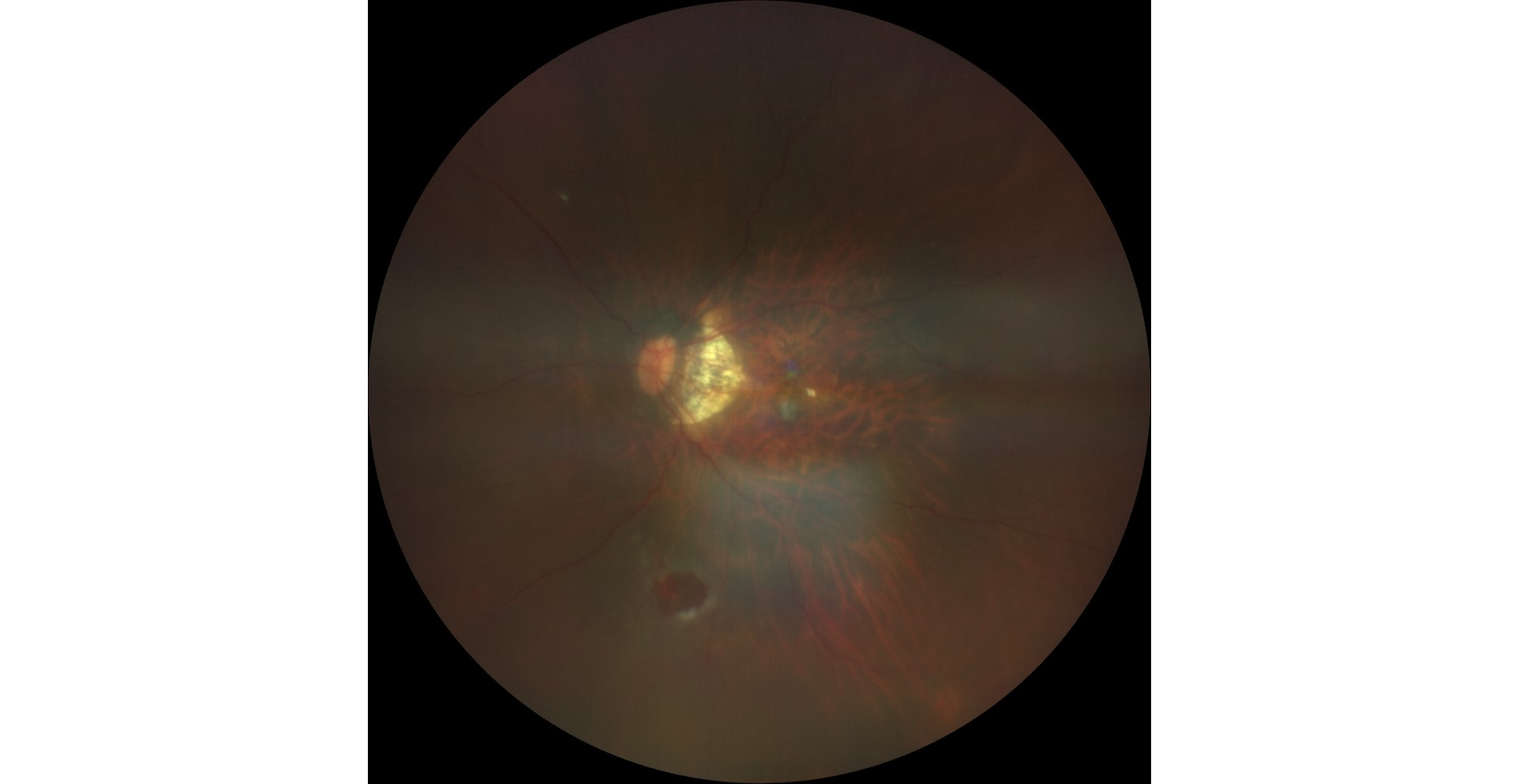 The First Autologous Retinal Transplant (ART) Performed at Hospital ...