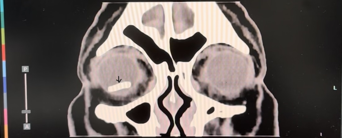 First Usage of Nitinol Stone Basket For Intraocular Foreign Body (IOFB ...